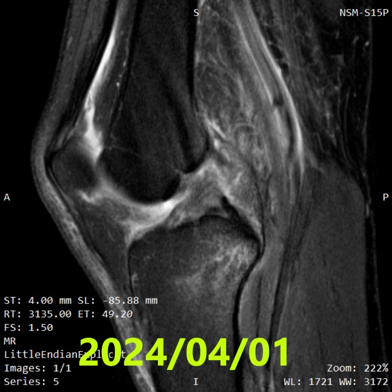 病例45：ACL 無手術達成自然癒合｜MRI Ihara III → ACLOAS 1