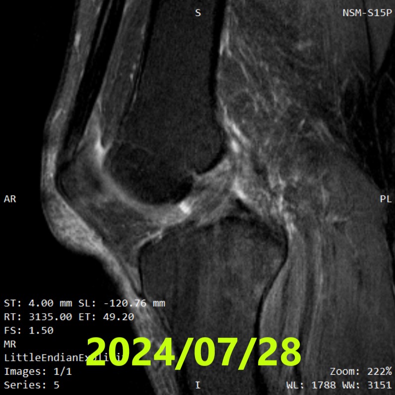 Caso 45: El LCA sana sin cirugía | RM Ihara III → ACLOAS 1