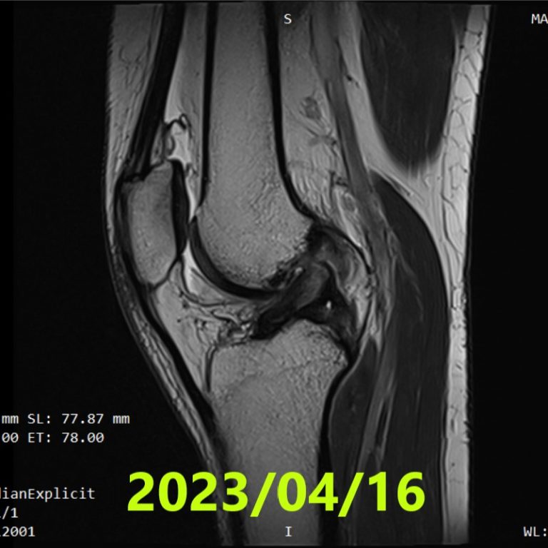 Caso 48｜Rottura completa del LCA: guarigione naturale senza intervento ...